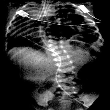 Congenital Diaphragmatic Hernia International Symposium Meeting ...