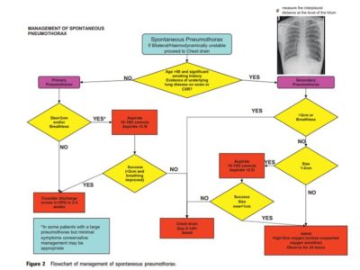 Spontaneous Pneumothorax | British Association of Paediatric Surgeons