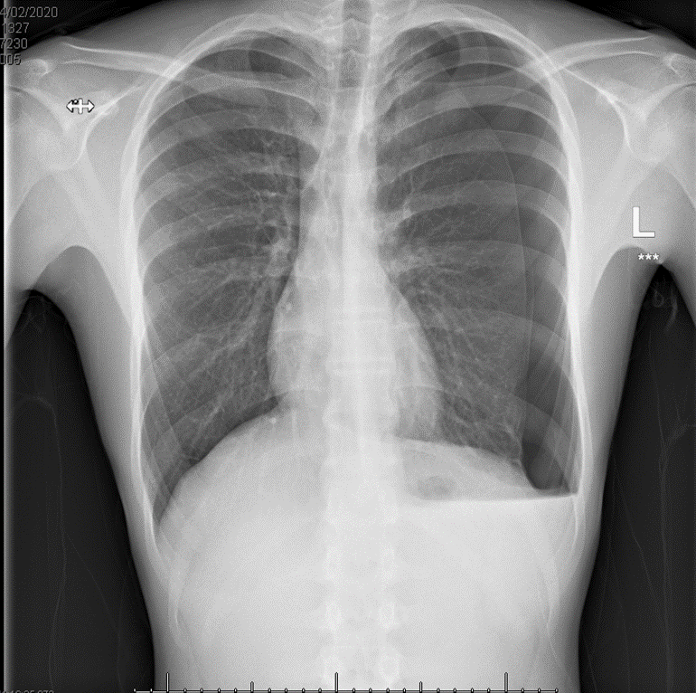 Bilateral pneumothorax | British Association of Paediatric Surgeons