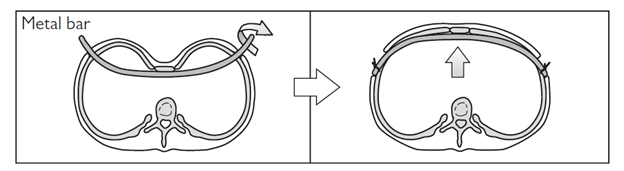 Chest Wall Deformity | British Association of Paediatric Surgeons
