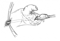 Orchidopexy | British Association of Paediatric Surgeons