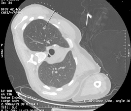 CT scan | British Association of Paediatric Surgeons