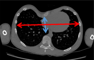 Chest Wall Deformity | British Association of Paediatric Surgeons