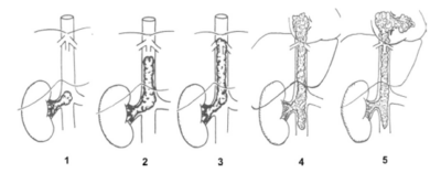 Wilms’ Tumour (nephroblastoma) | British Association of Paediatric Surgeons